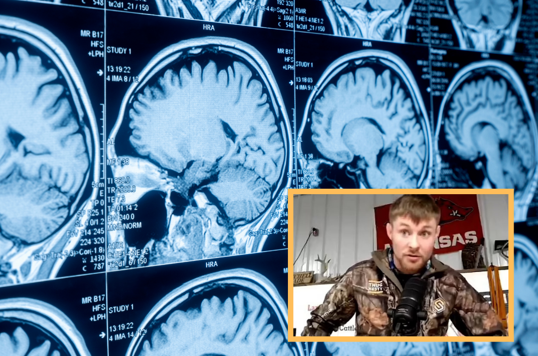 Link Between Brain Damage And Antisemitism Found In UFC Fighter’s Brain ...